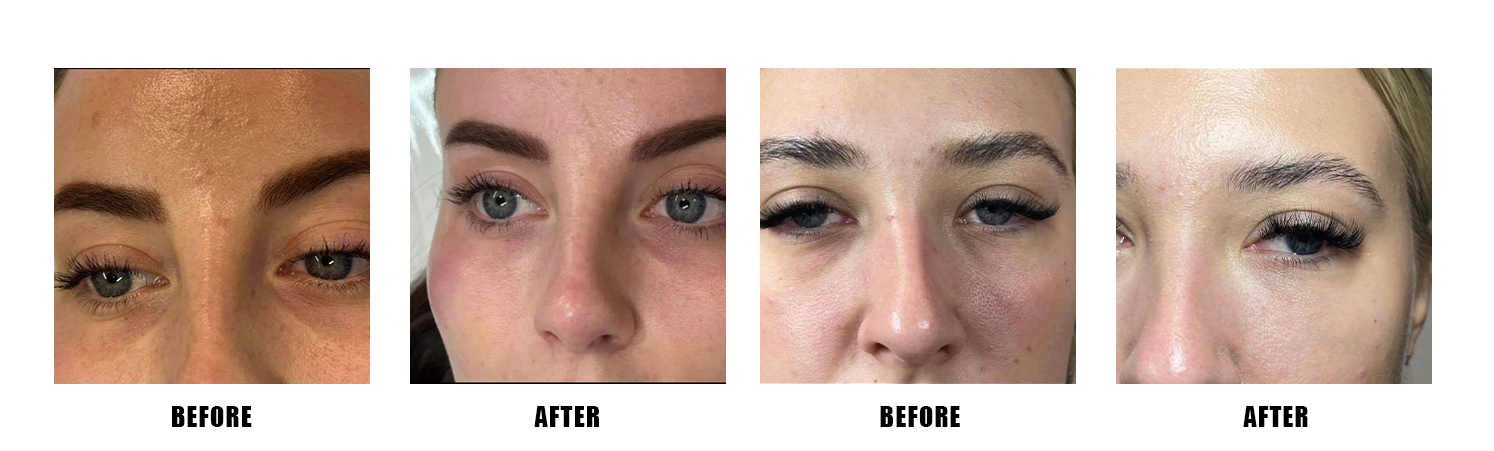 Tear Trough Filler - Faceworks By Nina
